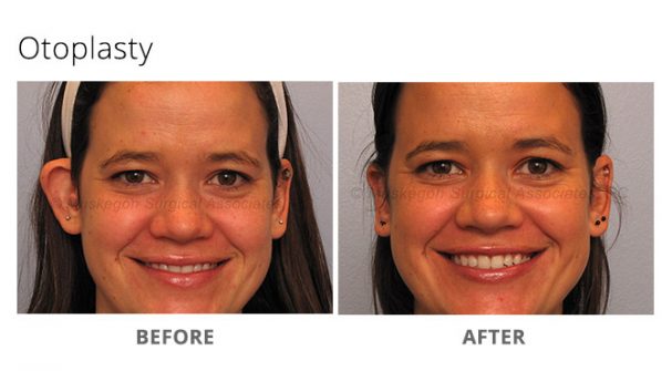 Ear Reshaping - MSA Plastic Surgery