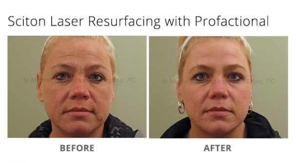 Sciton Laser Treatments - MSA Plastic Surgery