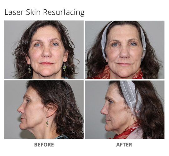 Sciton Laser Treatments - MSA Plastic Surgery