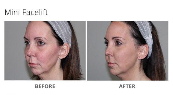 Mini Facelift - MSA Plastic Surgery