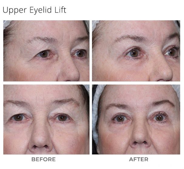 Eyelid Lift - MSA Plastic Surgery
