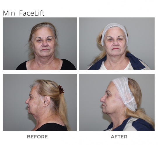 Mini Facelift - MSA Plastic Surgery